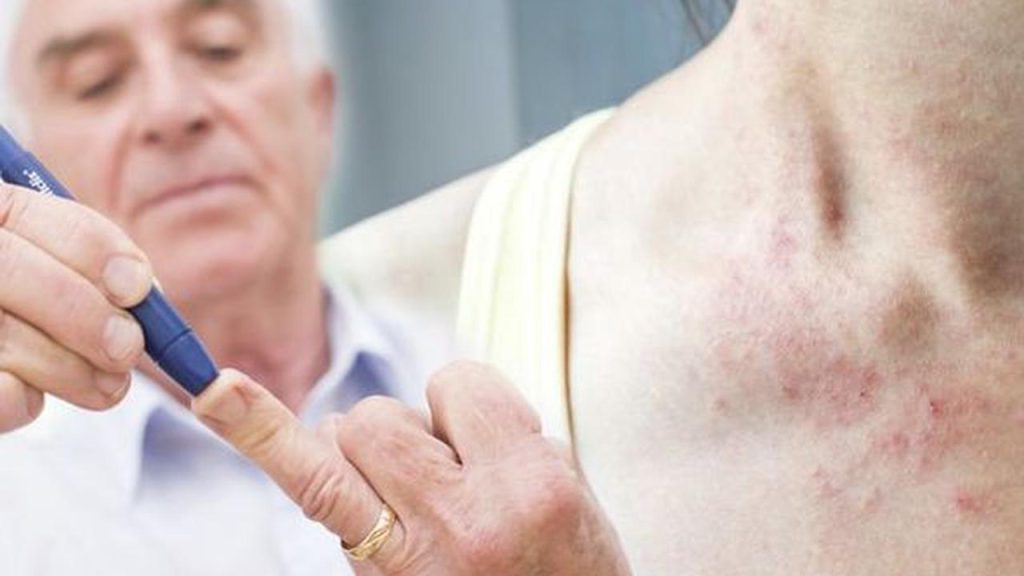 Diabetes Sores - Causes and Symptoms - HealthRemedy123 | Easy Health ...